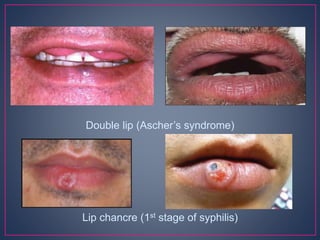 Intra oral examination (lips and labial mucosa) | PPT