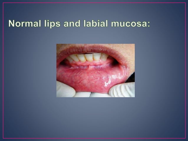 Intra oral examination (lips and labial mucosa)