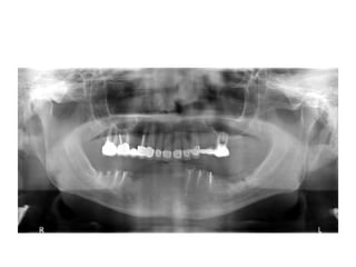 Intra oral photographs and pano cbct for Dental Implants at The Dental ...
