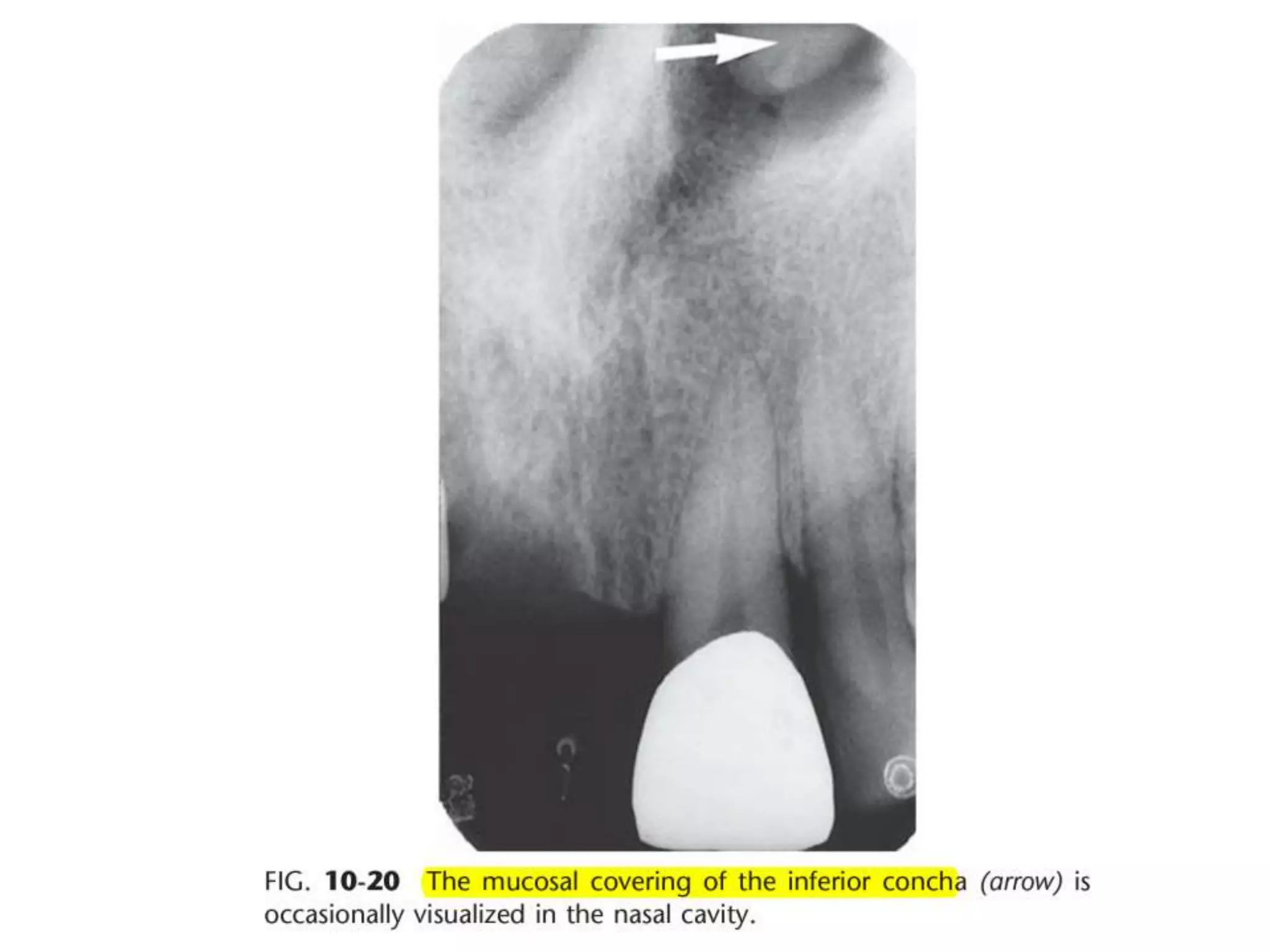 Intraoral radiographic anatomy | PPTX