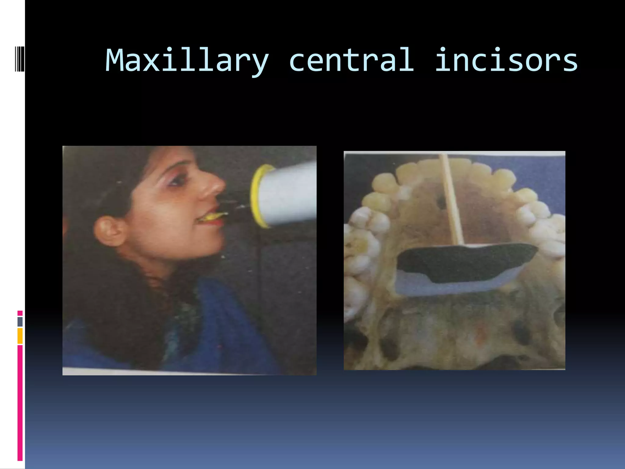 Intra oral radiographs | PPTX