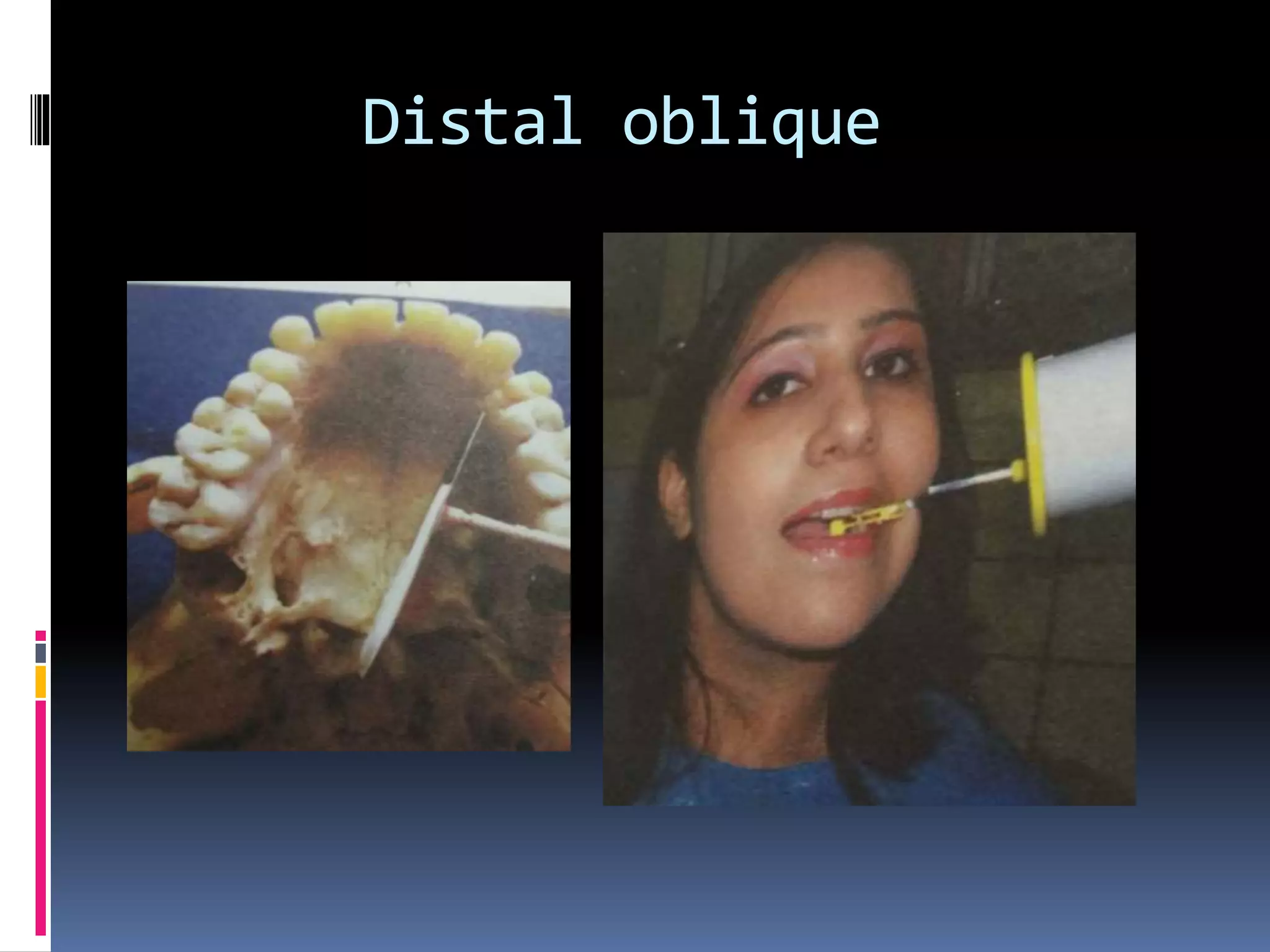 Intra oral radiographs | PPTX