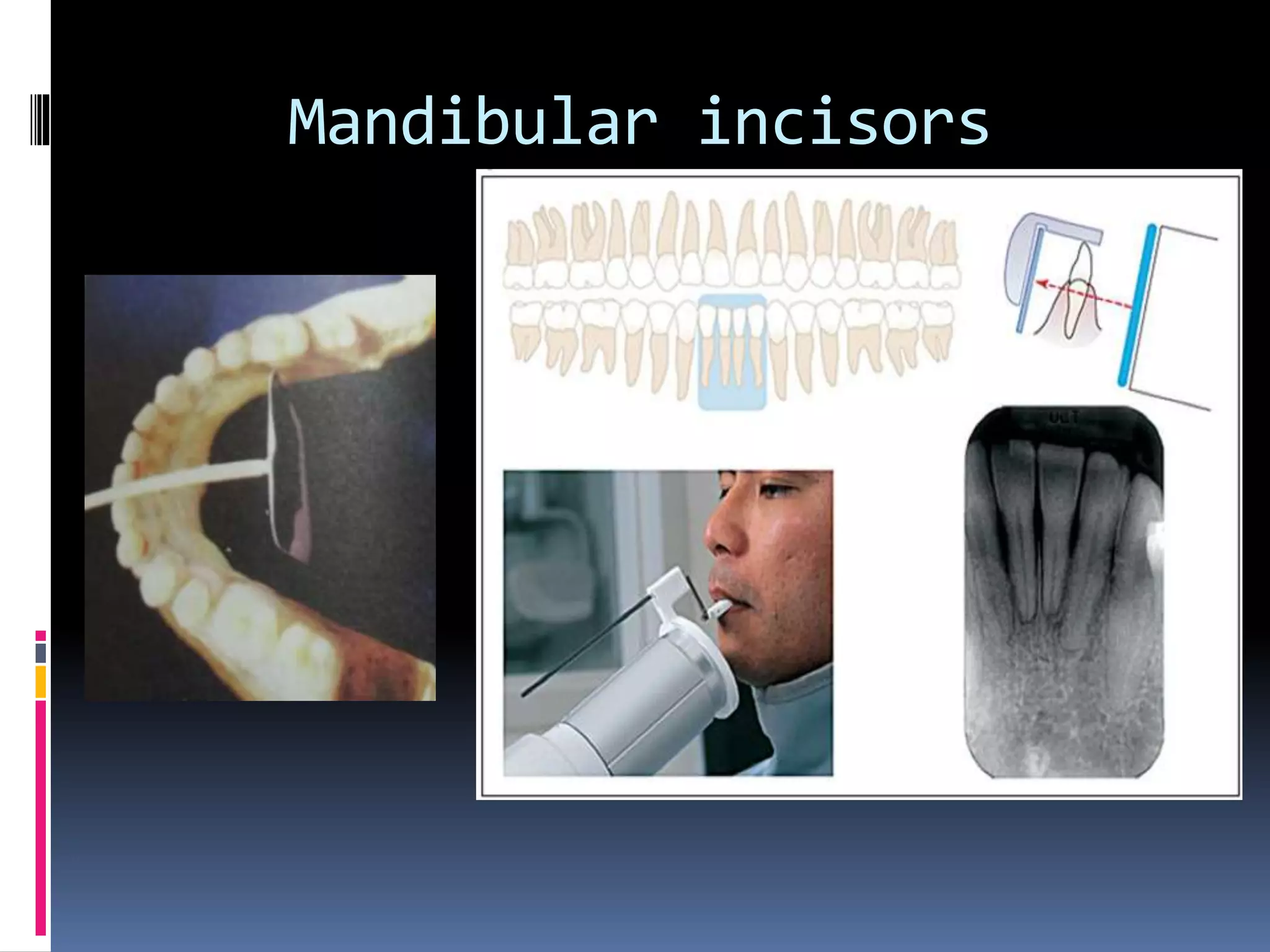 Intra oral radiographs | PPTX