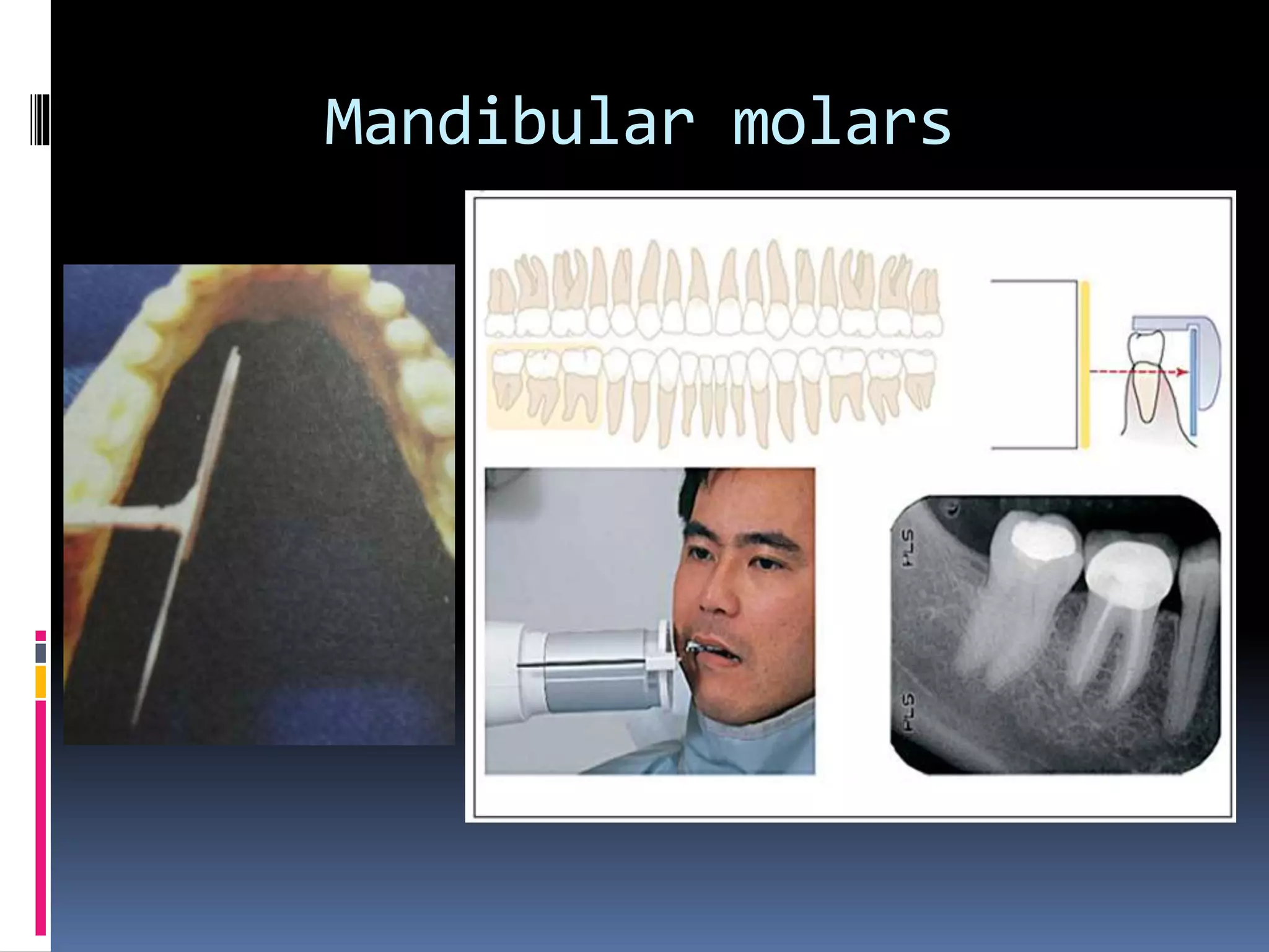 Intra oral radiographs | PPTX
