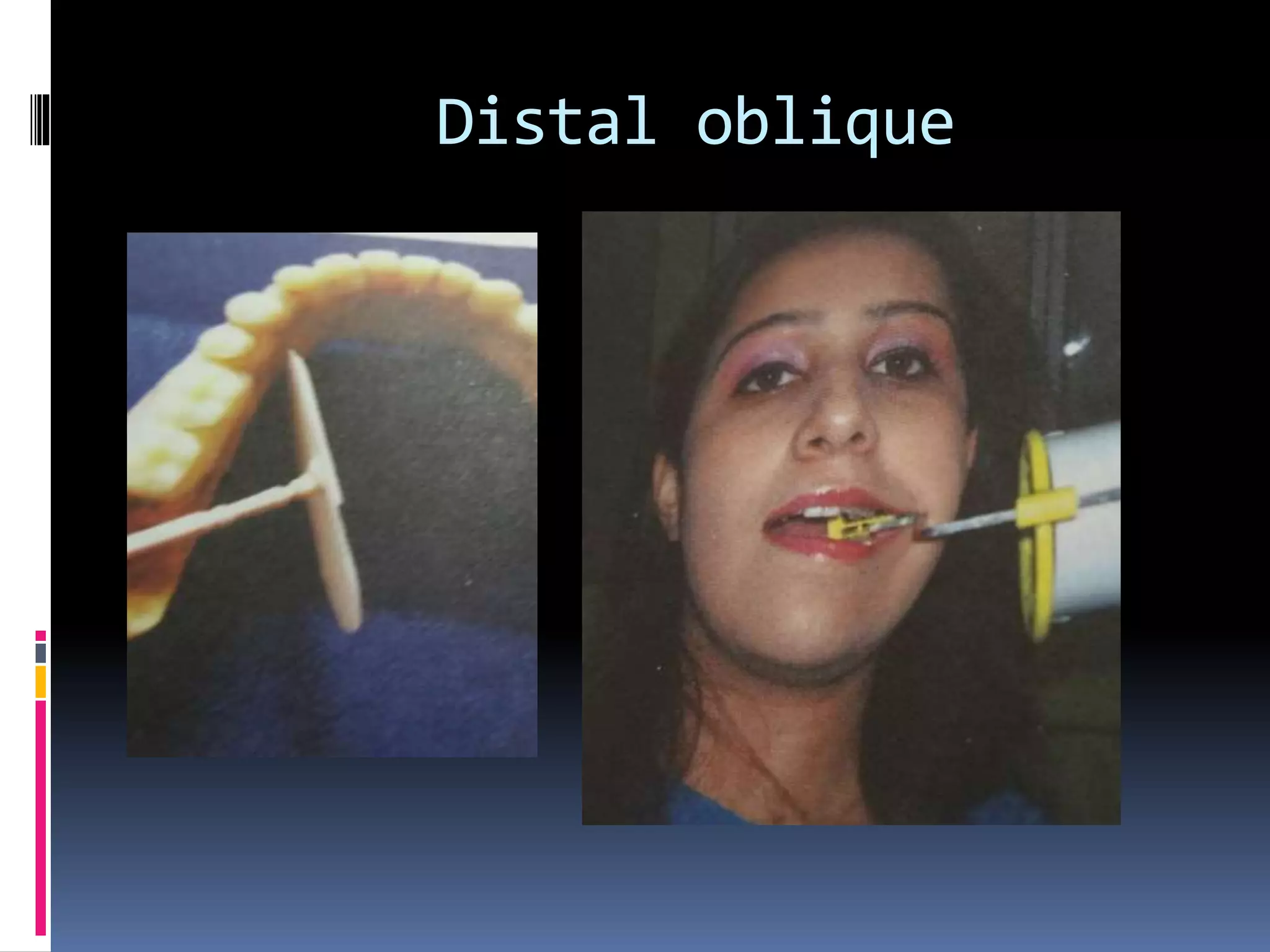 Intra oral radiographs | PPTX