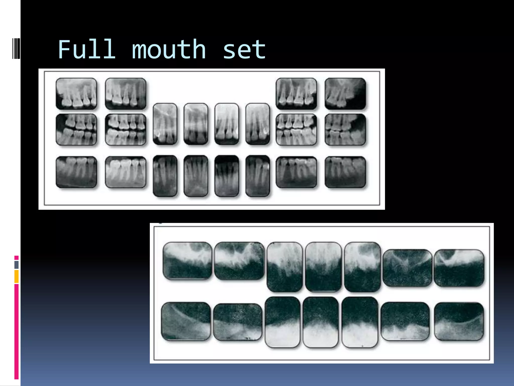 Intra oral radiographs | PPTX