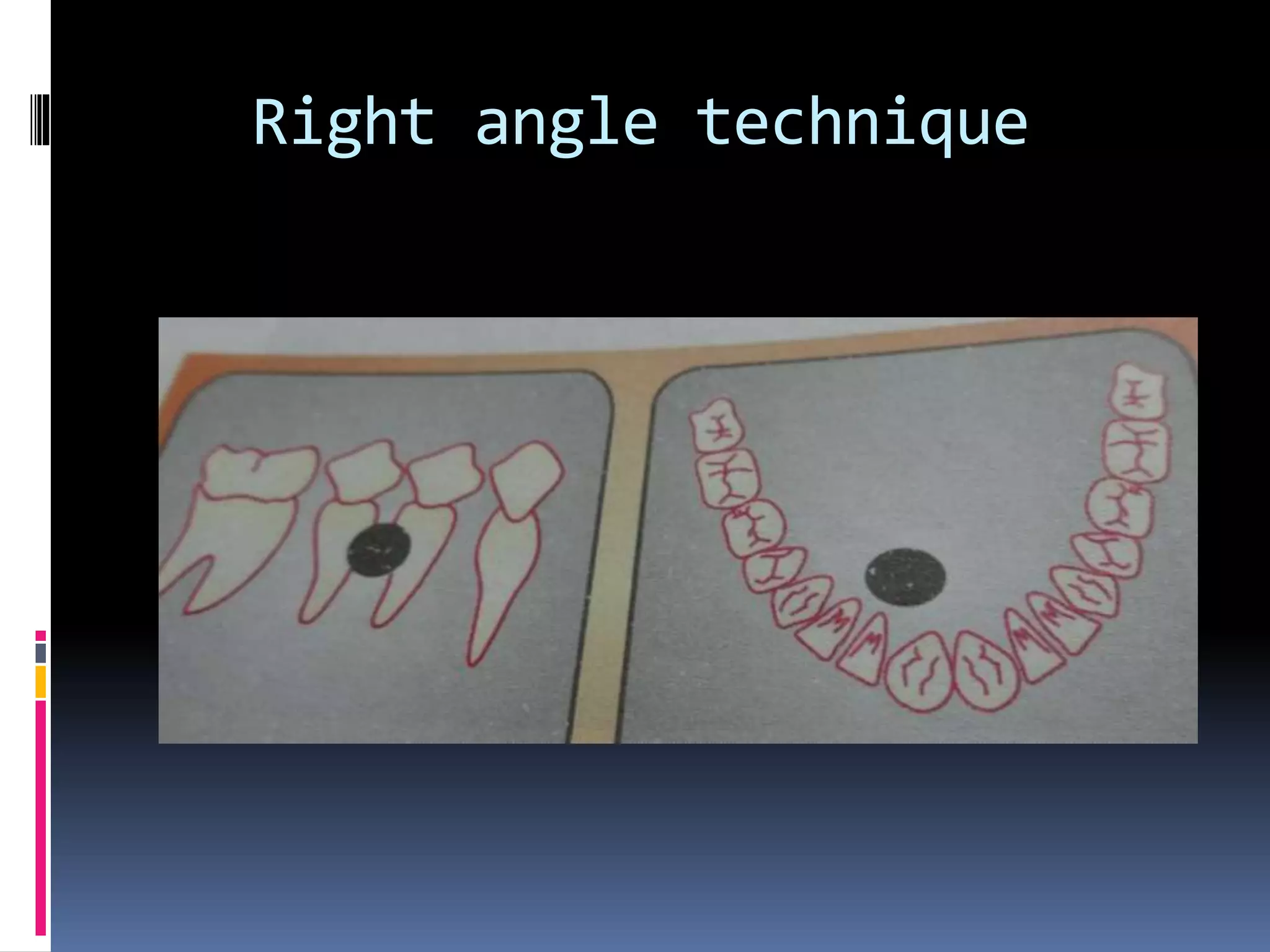 Intra oral radiographs | PPTX