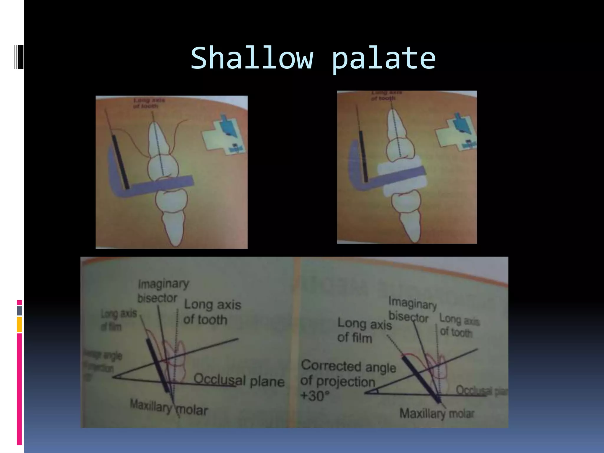 Intra oral radiographs | PPTX