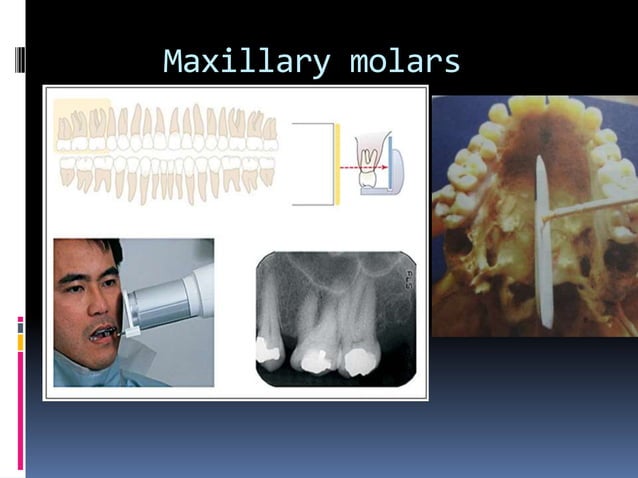Intra oral radiographs | PPTX