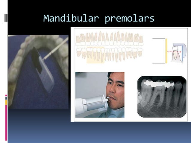 Intra oral radiographs | PPTX