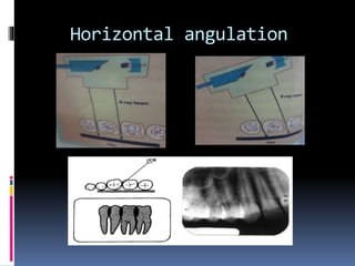 Intra oral radiographs | PPTX