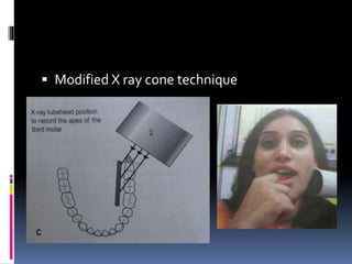 Intra oral radiographs | PPTX