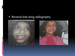 Intra oral radiographs | PPTX