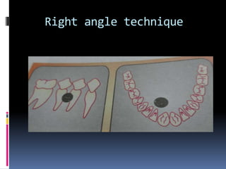 Intra oral radiographs | PPTX