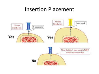 Intraosseous | PPTX