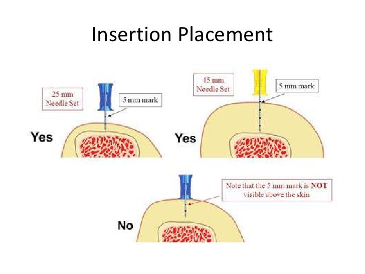 intraosseous