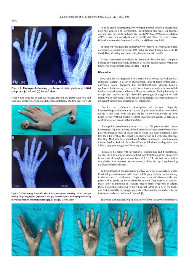 Intraosseous Haemophillic Pseudotumour of distal digital phalanx – A ...