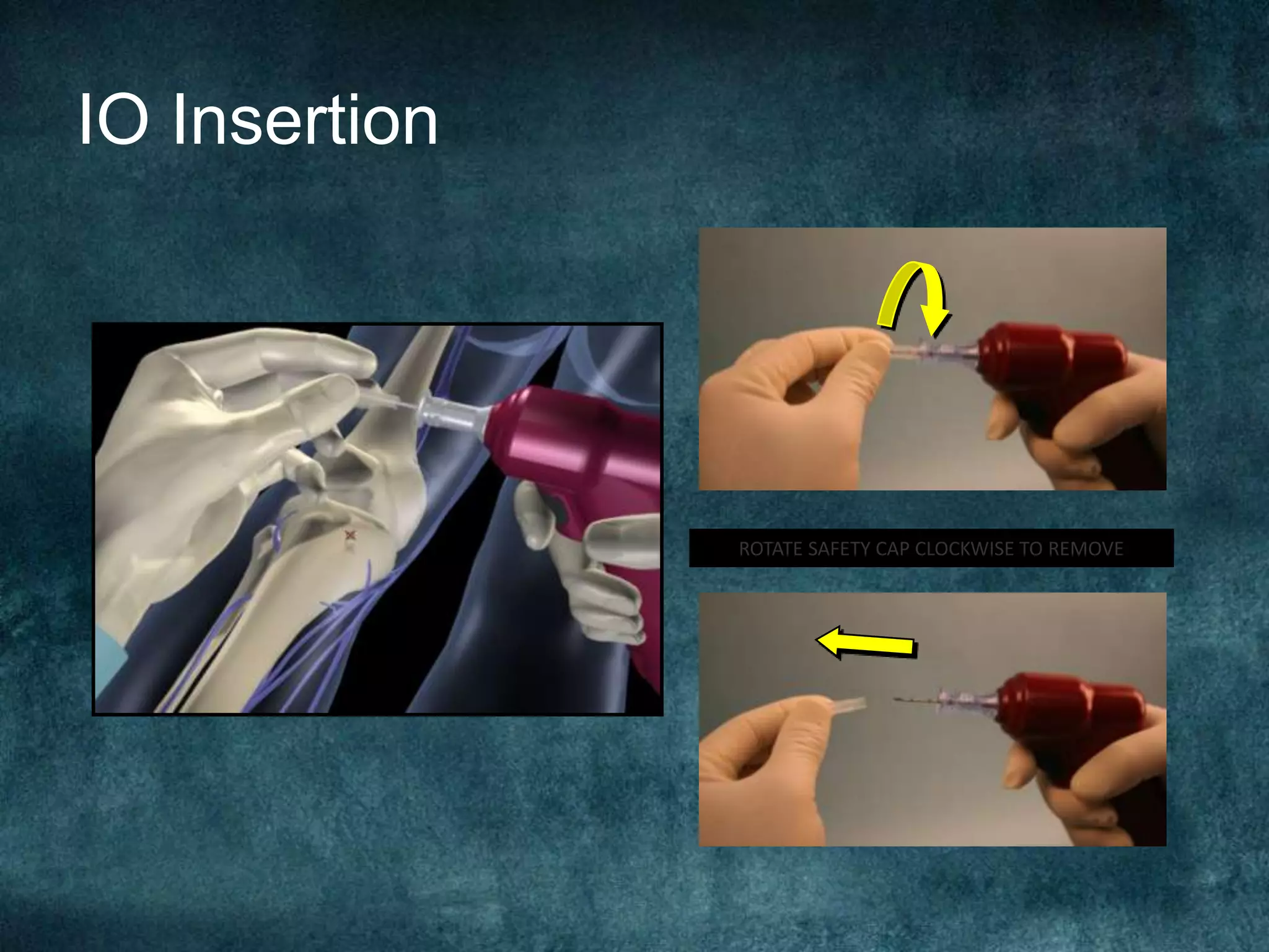 Intraosseous infusion mhs 536 | PPTX