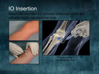 Intraosseous infusion mhs 536 | PPTX