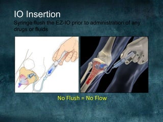 Intraosseous infusion mhs 536 | PPTX