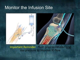 Intraosseous infusion mhs 536 | PPTX