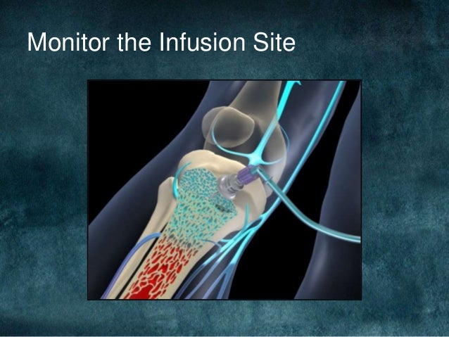 Intraosseous infusion mhs 536