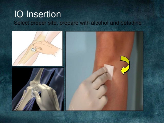 Intraosseous infusion mhs 536