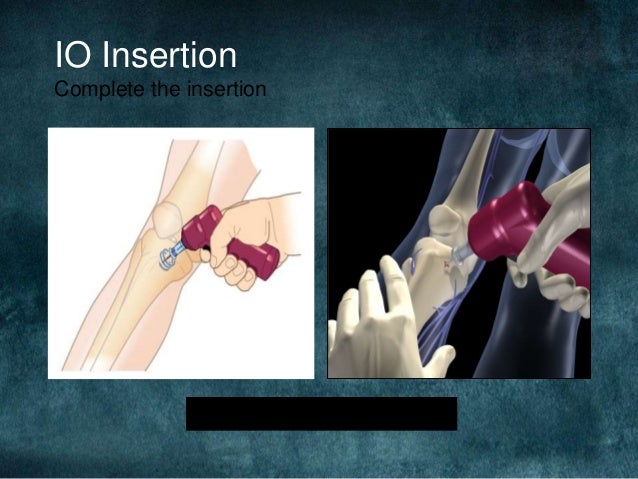 Intraosseous infusion mhs 536