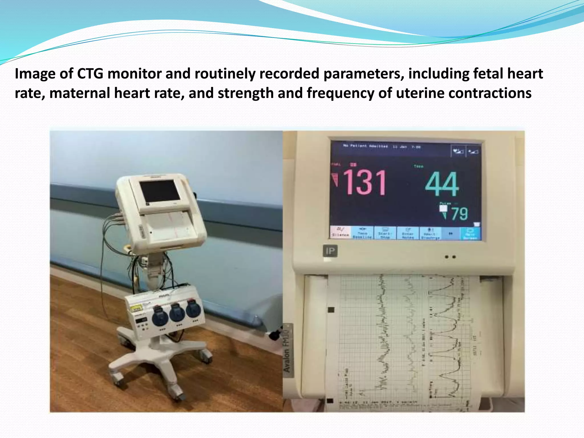 Intrapartum assessment of fetal well being (1) | PPTX