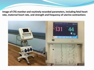 Intrapartum assessment of fetal well being (1) | PPTX