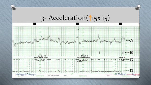 Intrapartum assessment of fetal wellbeing
