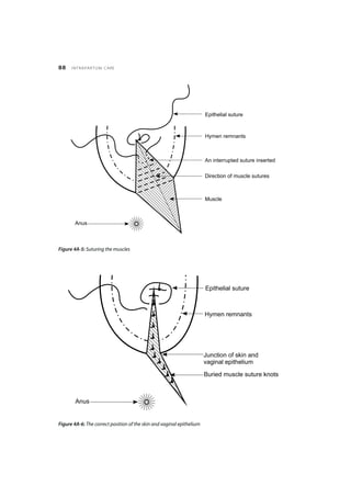Intrapartum Care: Skills workshop Performing and repairing an ...