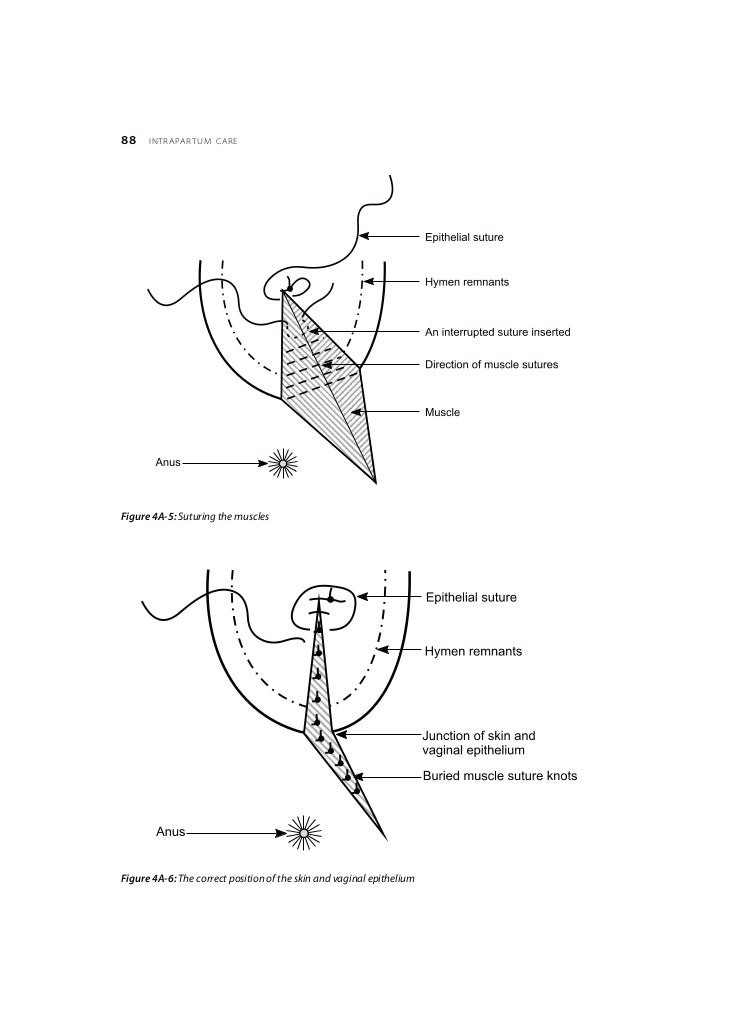 Intrapartum Care: Skills workshop Performing and repairing an episiot…