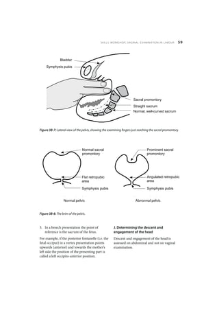 Intrapartum Care: Skills workshop Vaginal examination in labour | PDF