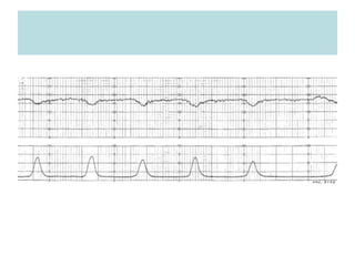 Intrapartum fetal assessment | PPTX