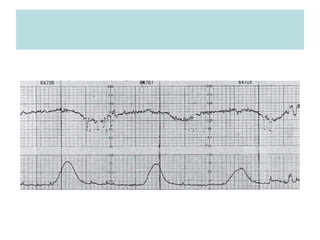 Intrapartum fetal assessment | PPTX