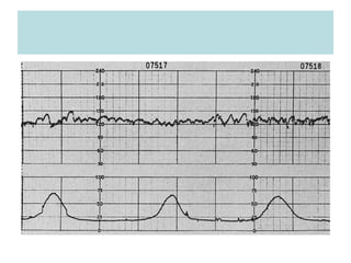 Intrapartum fetal assessment | PPTX