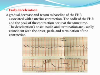 Intrapartum fetal heart rate assessment | PPTX