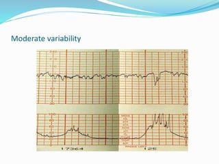 Intrapartum fetal heart rate assessment | PPTX