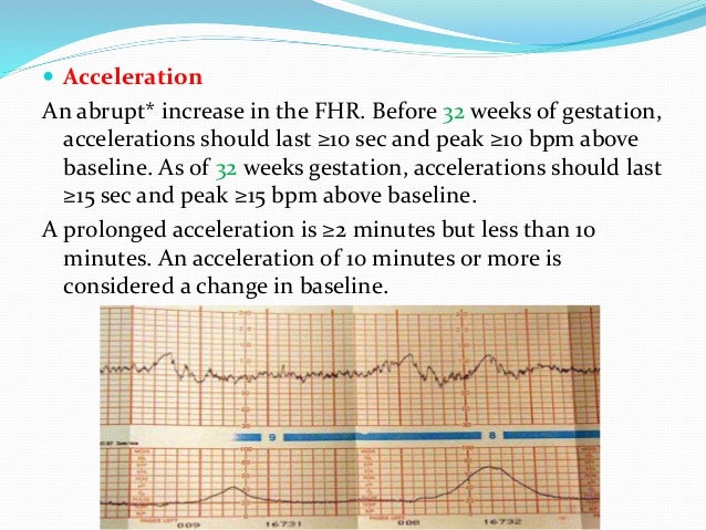 Intrapartum fetal heart rate assessment