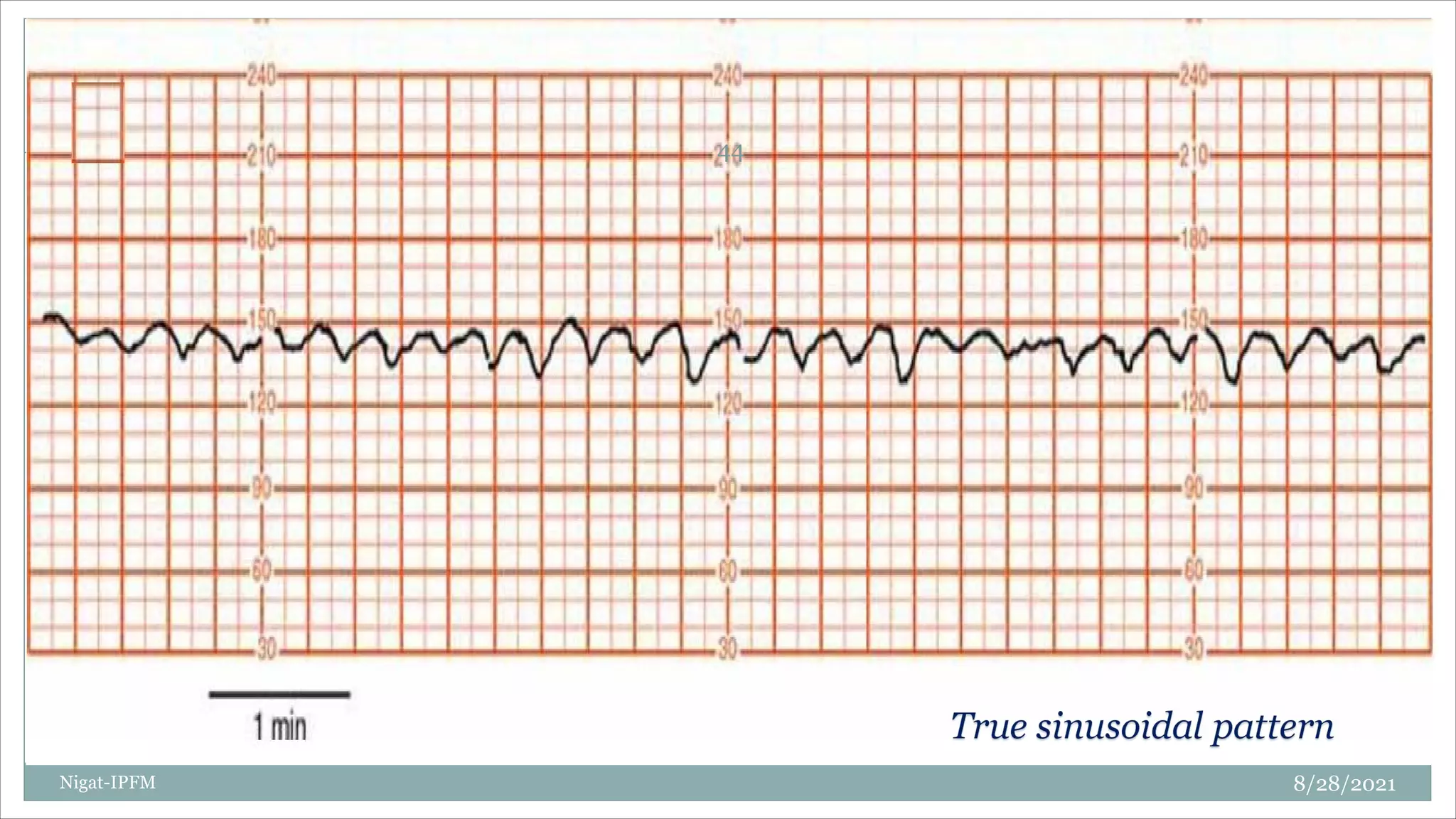 Intrapartum fetal monitoring | PDF