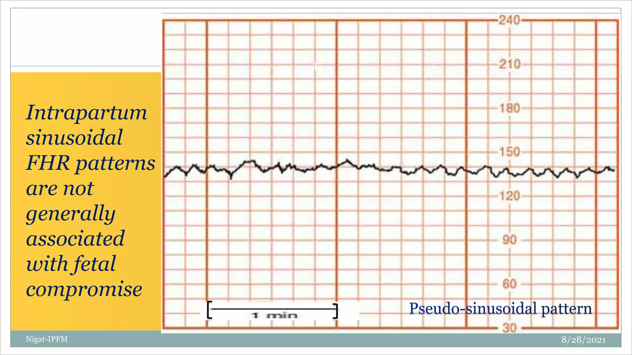 Intrapartum fetal monitoring | PDF