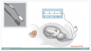 Intrapartum fetal monitoring | PDF