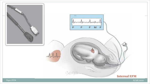 Intrapartum fetal monitoring | PDF | Pregnancy | Reproductive Health