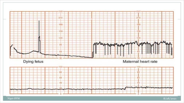 Intrapartum fetal monitoring | PDF | Pregnancy | Reproductive Health