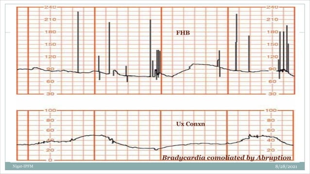 Intrapartum fetal monitoring | PDF | Pregnancy | Reproductive Health