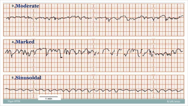 Intrapartum fetal monitoring | PDF | Pregnancy | Reproductive Health