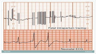 Intrapartum fetal monitoring | PDF
