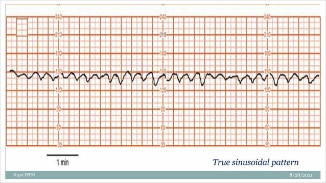 Intrapartum fetal monitoring | PDF | Pregnancy | Reproductive Health