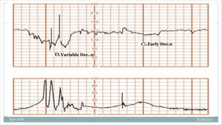Intrapartum fetal monitoring | PDF